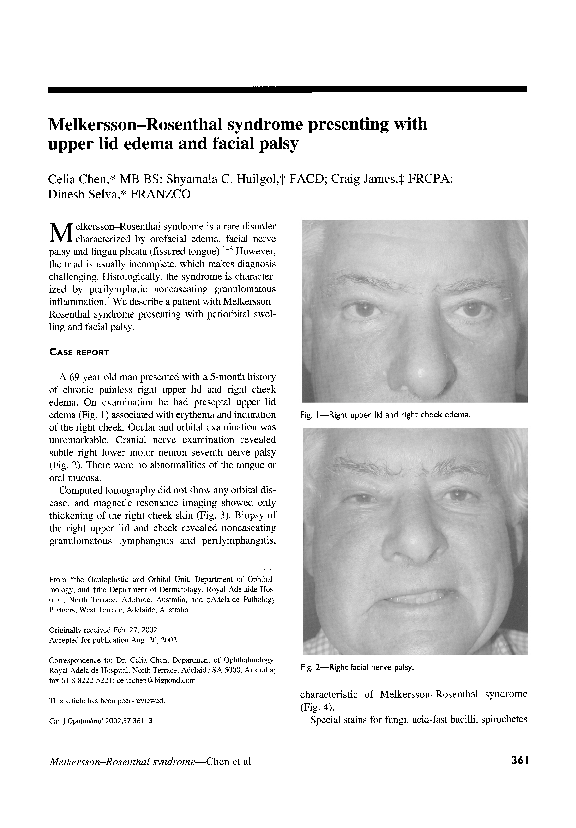 Pdf Melkersson Rosenthal Syndrome Presenting With Upper Lid Edema And