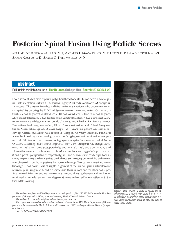 (PDF) Posterior Spinal Fusion Using Pedicle Screws
