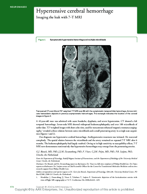 (PDF) Hypertensive cerebral hemorrhage: Imaging the leak with 7-T MRI