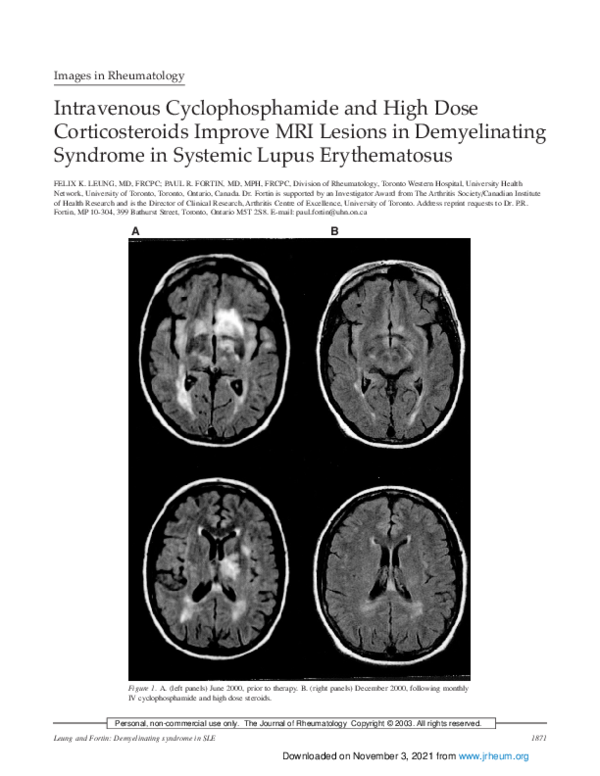 (PDF) Intravenous cyclophosphamide and high dose corticosteroids ...