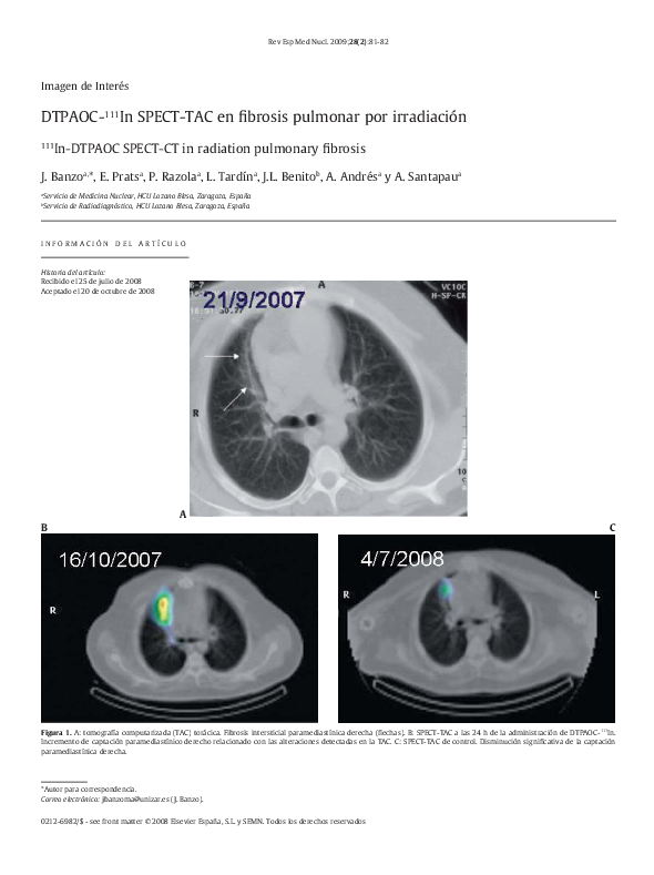 (PDF) DTPAOC- 111In SPECT-TAC en fibrosis pulmonar por irradiación