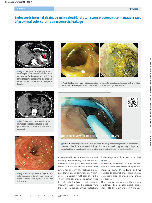 (PDF) Endoscopic internal drainage using double-pigtail stent placement ...