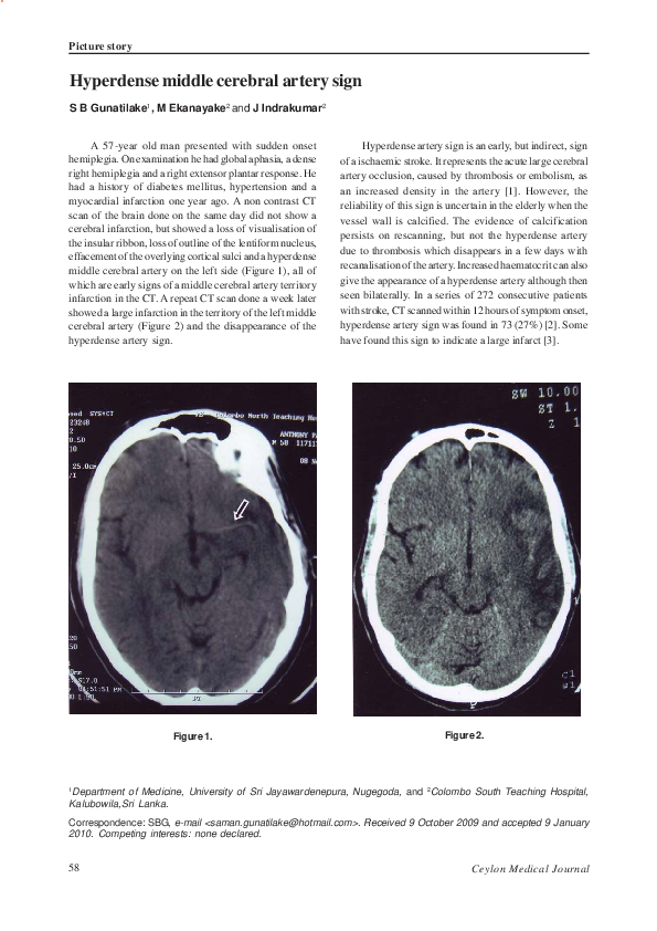 (PDF) Hyperdense middle cerebral artery sign