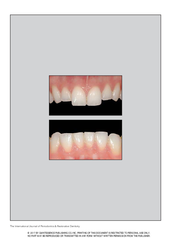 (PDF) Comparison of Periodontal Biotypes Between Maxillary and ...