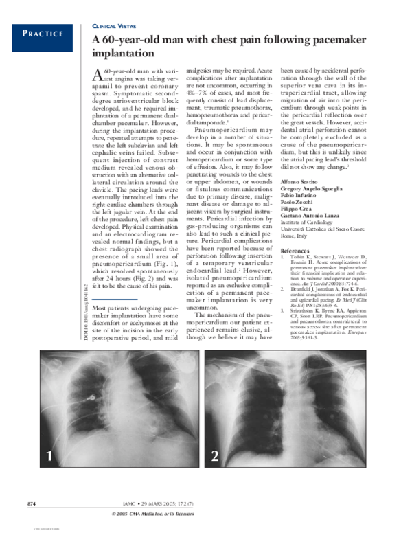 (PDF) A 60-year-old man with chest pain following pacemaker implantation