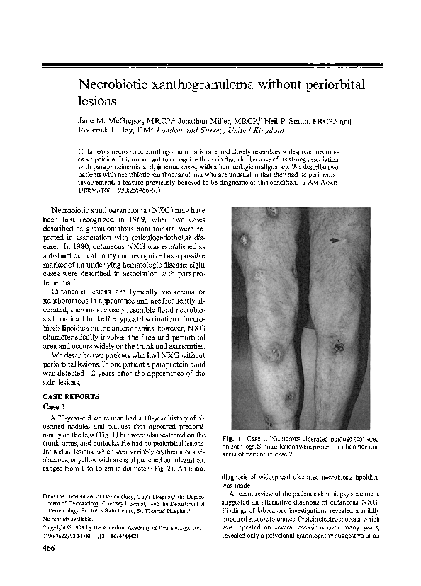 (PDF) Necrobiotic xanthogranuloma without periorbital lesions