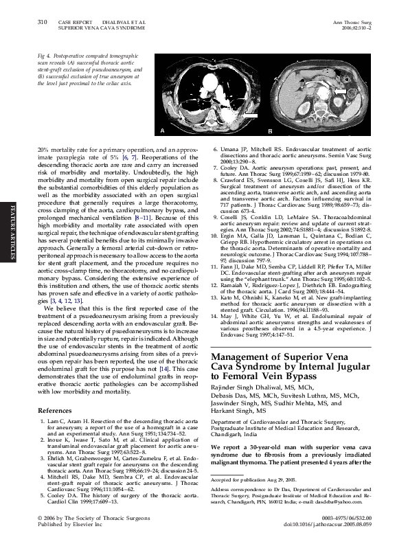 (PDF) Management of Superior Vena Cava Syndrome by Internal Jugular to ...