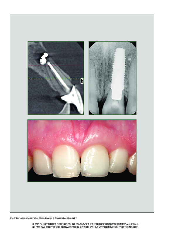(PDF) Guided Tissue Preservation: Clinical Application of a New Provisional Restoration Design ...