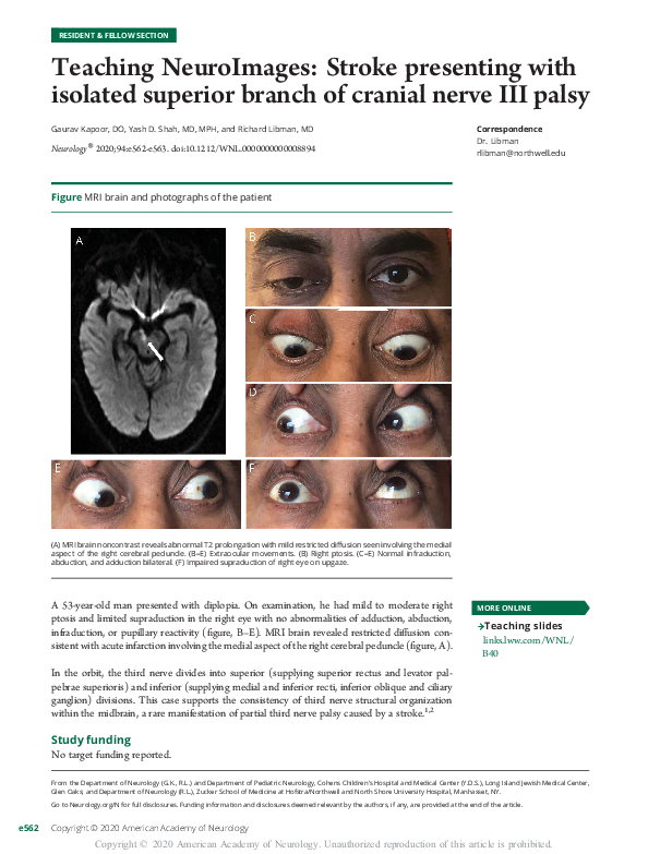 (PDF) Teaching NeuroImages: Stroke presenting with isolated superior ...