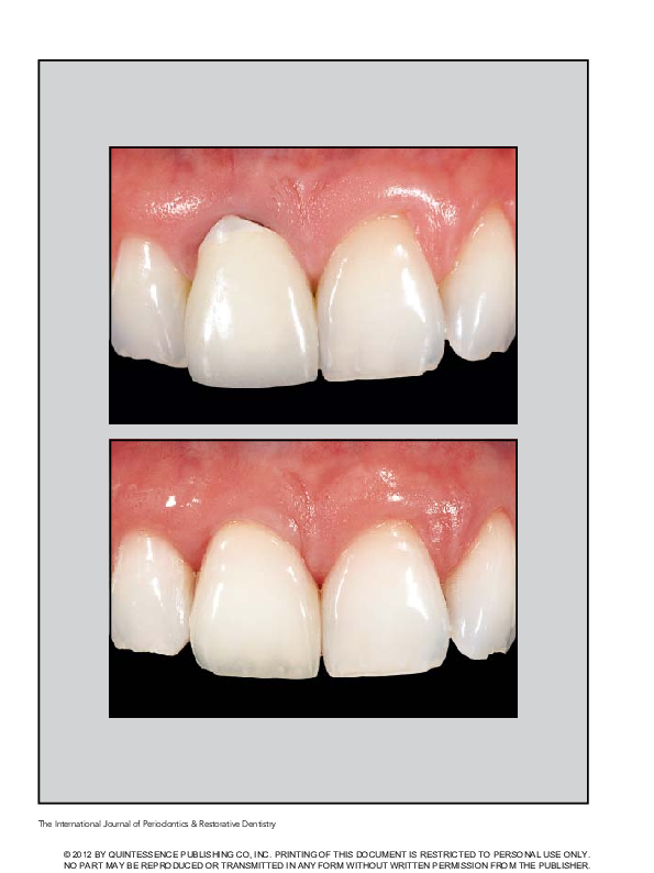 (PDF) Immediate implant placement and provisionalization with and without a connective tissue ...