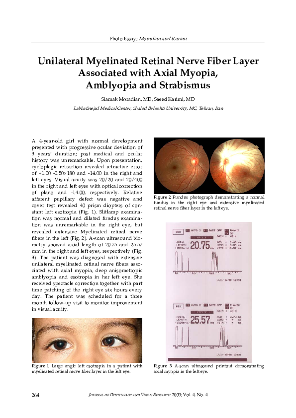 (PDF) Unilateral myelinated retinal nerve fiber layer associated with ...
