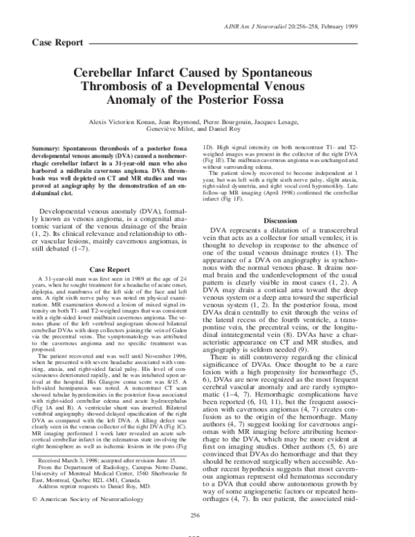 (PDF) Cerebellar Infarct Caused by Spontaneous Thrombosis of a ...
