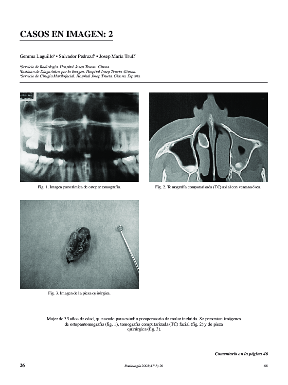 (PDF) Rinolito en fosa nasal