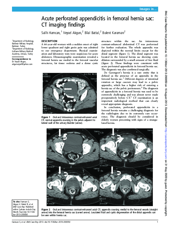(PDF) Acute perforated appendicitis in femoral hernia sac: CT imaging ...