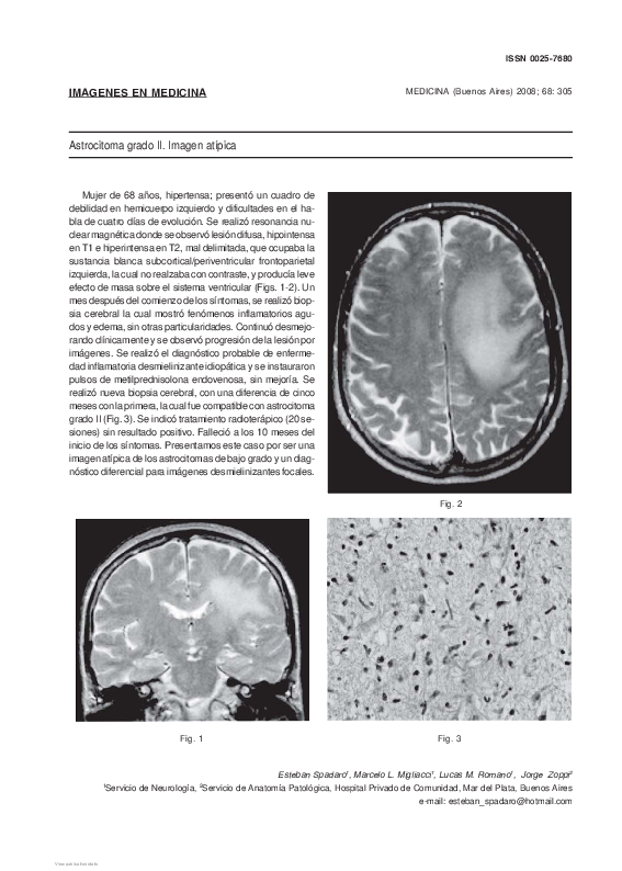 (PDF) Astrocitoma grado II: Imagen atípica