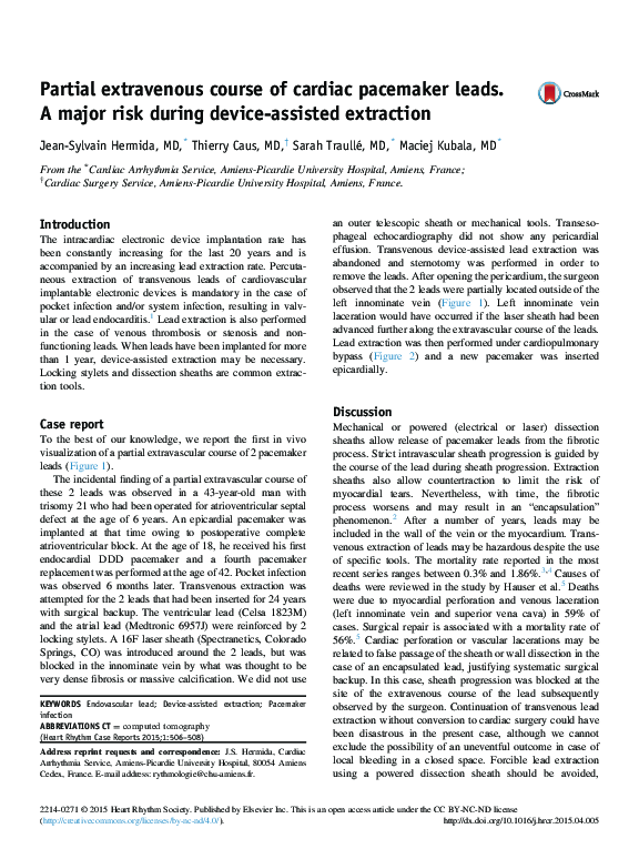 (PDF) Partial Extravenous Course of Cardiac Pacemaker Leads. A Major ...