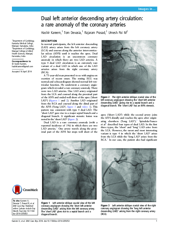 (PDF) Dual left anterior descending artery circulation: a rare anomaly ...