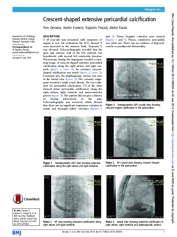(PDF) Crescent-shaped extensive pericardial calcification