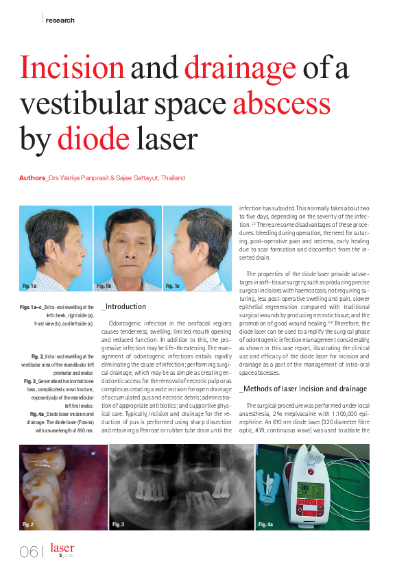 (PDF) Incision and drainage of a vestibular space abscess by diode laser