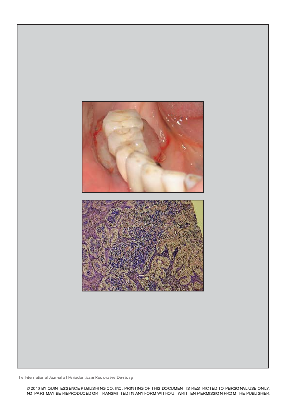 (PDF) Recurrent Pyogenic Granuloma Around Dental Implants: A Rare Case ...
