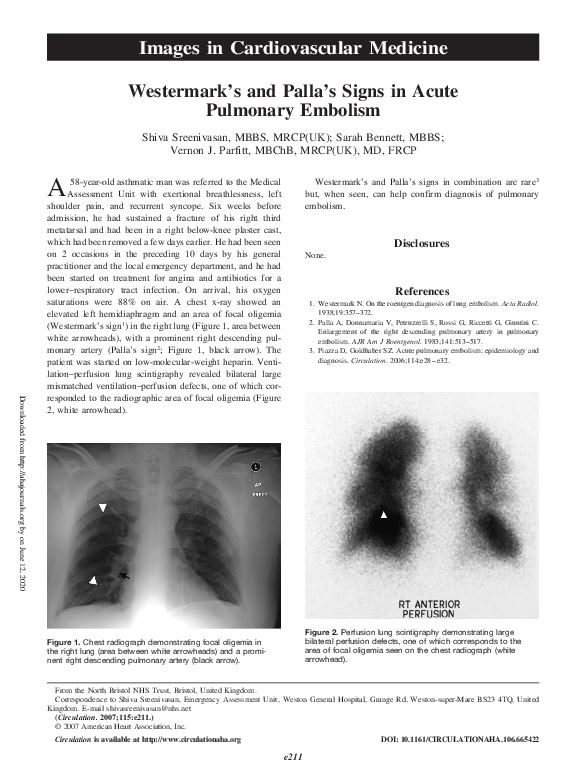 (PDF) Westermark’s and Palla’s Signs in Acute Pulmonary Embolism ...