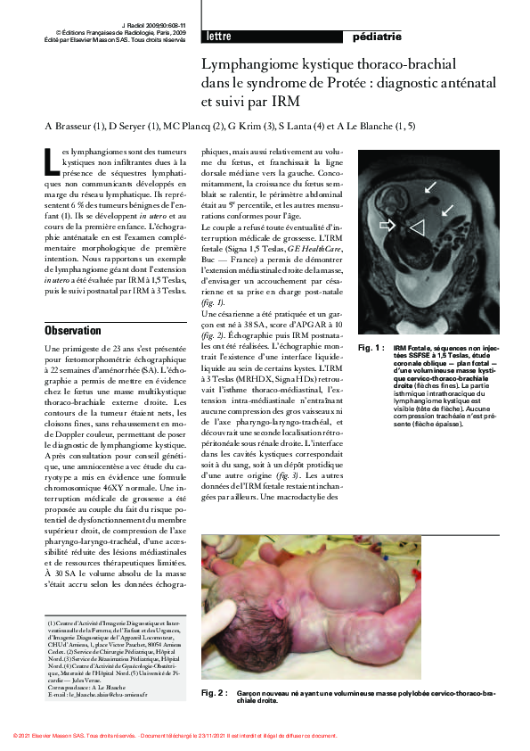(PDF) Lymphangiome kystique thoraco-brachial dans le syndrome de Protée ...