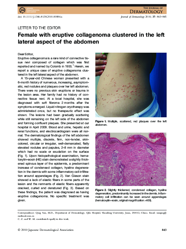 (PDF) Female with eruptive collagenoma clustered in the left lateral ...