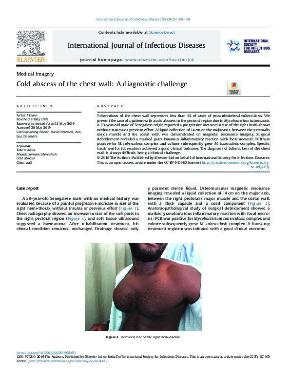 (PDF) Cold abscess of the chest wall: A diagnostic challenge