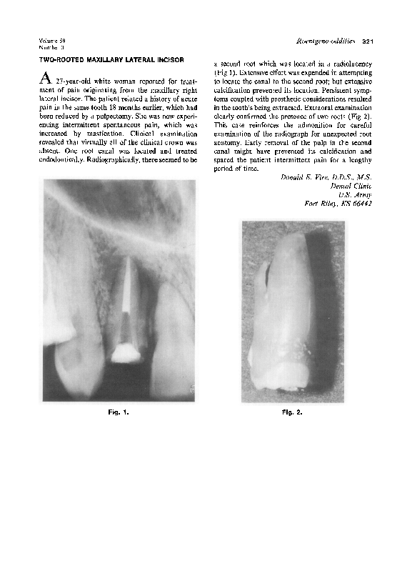 (PDF) Two-rooted maxillary lateral incisor