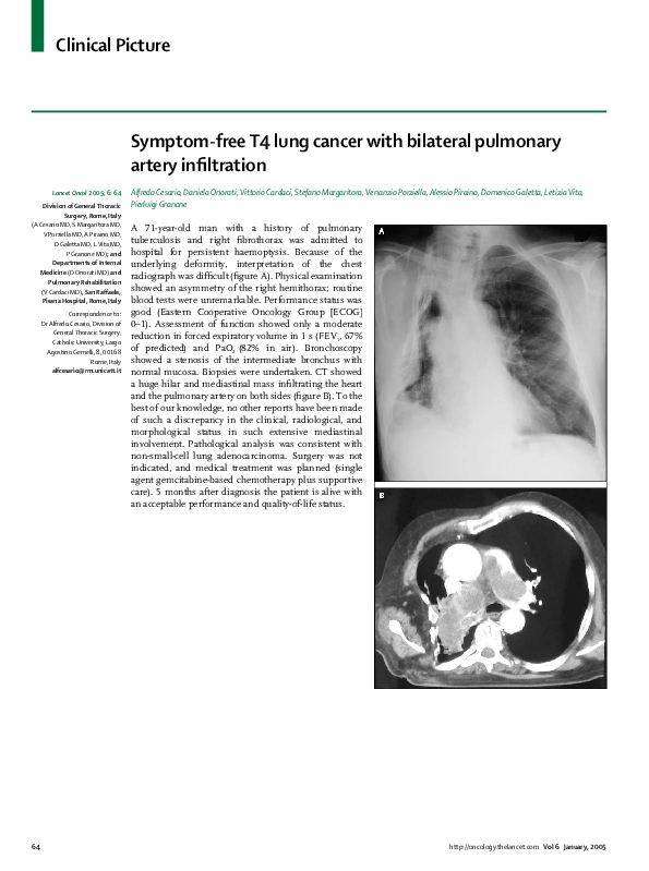 (PDF) Symptom-free T4 lung cancer with bilateral pulmonary artery ...