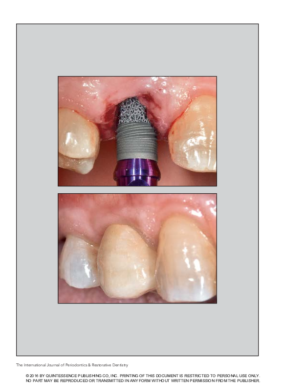 (PDF) Immediate Placement and Occlusal Loading of Single-Tooth Restorations on Partially ...