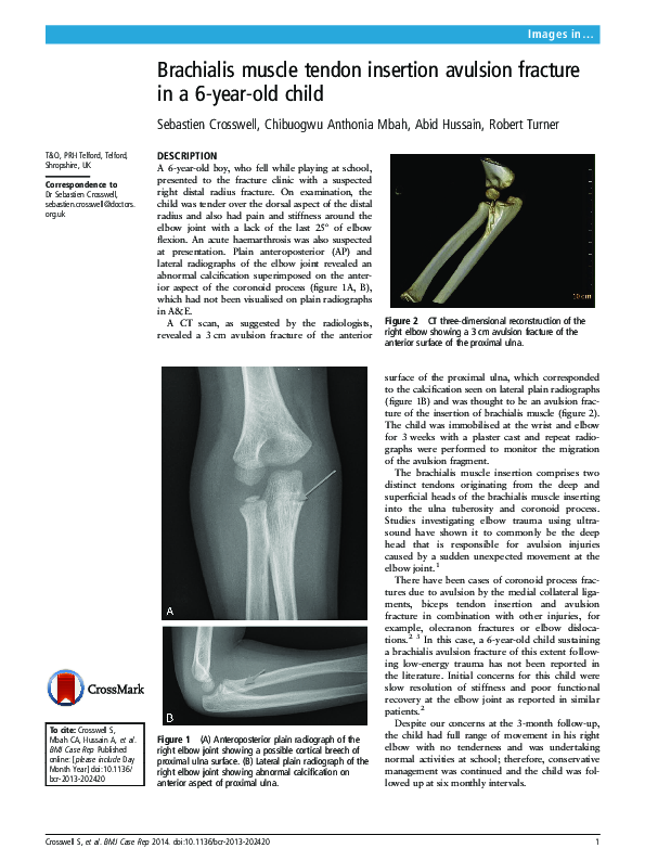 (PDF) Brachialis muscle tendon insertion avulsion fracture in a 6-year ...