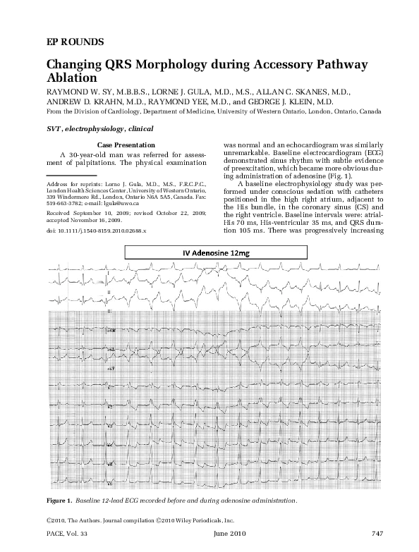 Changing QRS Morphology during Accessory Pathway Ablation