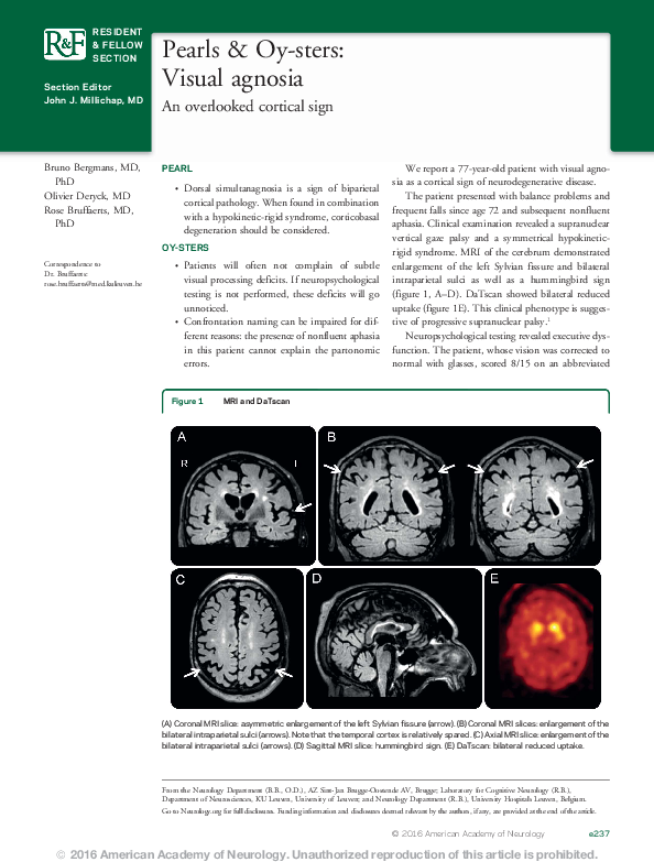 (PDF) Pearls & Oy-sters: Visual agnosia