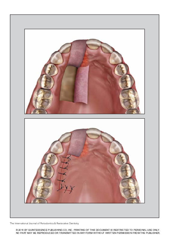 (PDF) Soft Tissue Closure of Grafted Extraction Sockets in the Anterior ...
