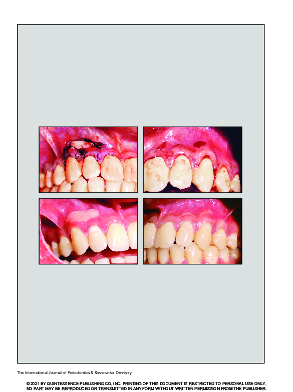 (PDF) Comparative Clinical Evaluation of Semilunar Coronally Positioned ...