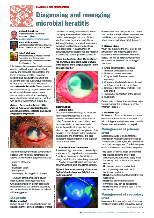 (PDF) Diagnosing and managing microbial keratitis