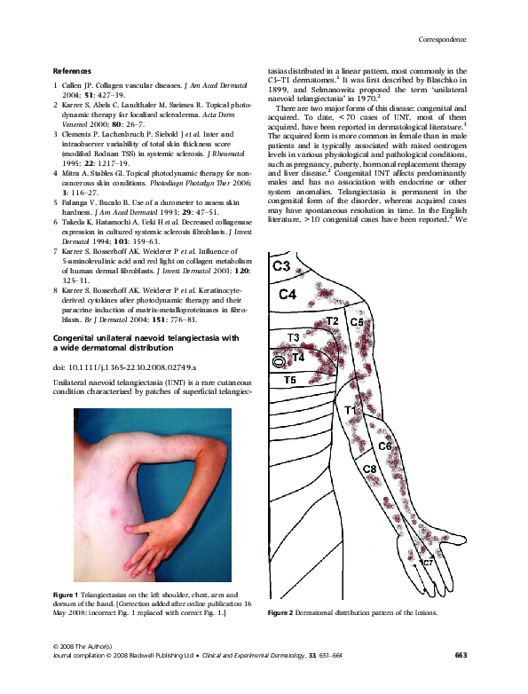(PDF) Congenital unilateral naevoid telangiectasia with a wide ...