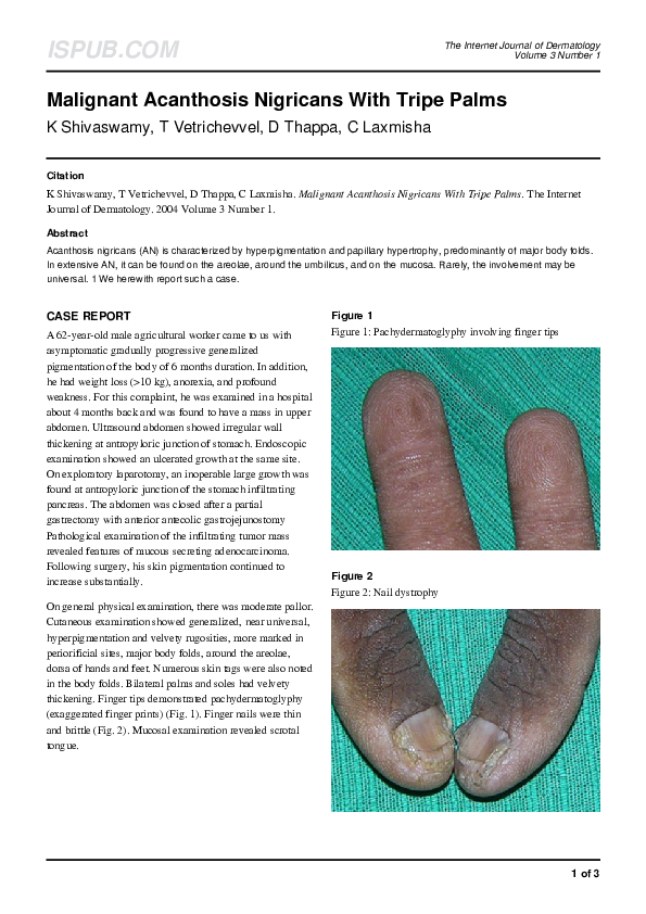 (PDF) Malignant Acanthosis Nigricans With Tripe Palms