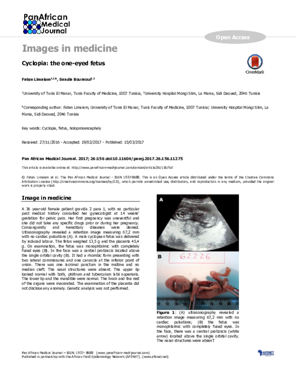 (PDF) Cyclopia: the one-eyed fetus