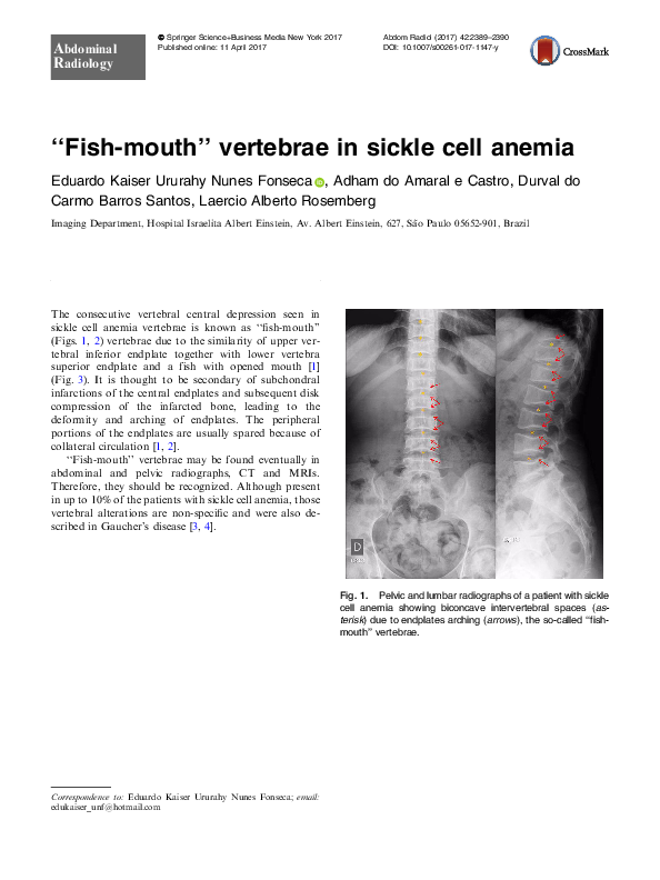(PDF) Fish-mouth" vertebrae in sickle cell anemia