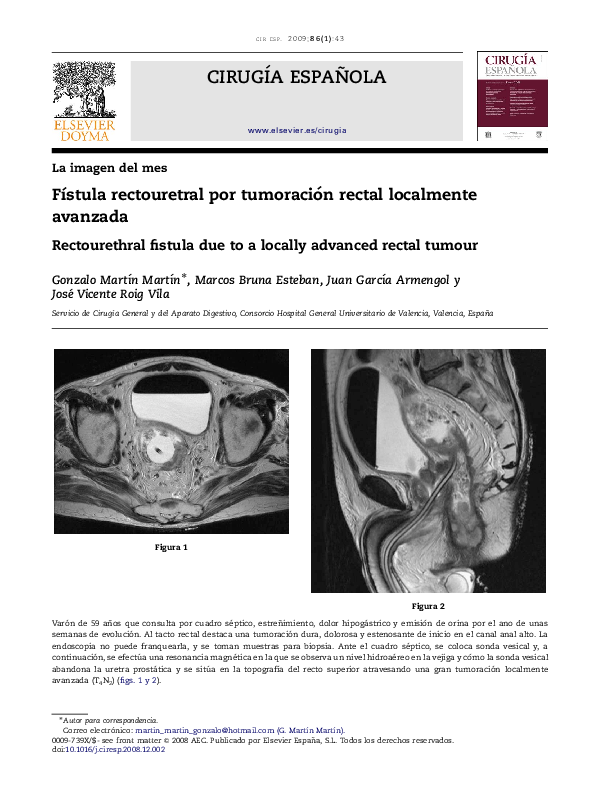 (PDF) Fístula rectouretral por tumoración rectal localmente avanzada