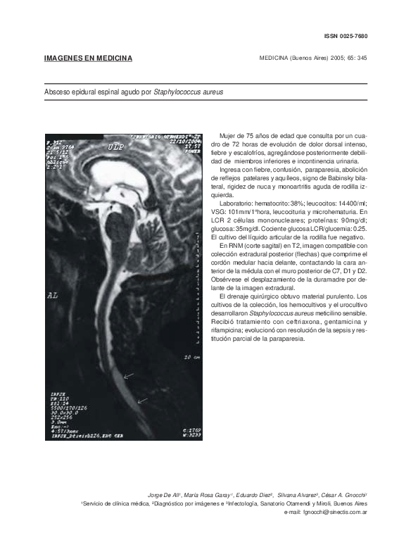 (PDF) Absceso epidural espinal agudo por Staphylococcus aureus
