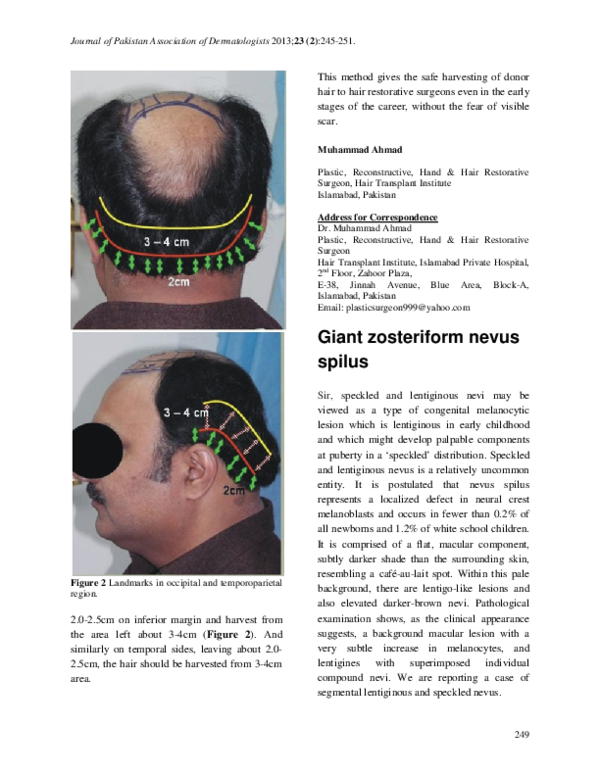 (PDF) Giant zosteriform nevus spilus