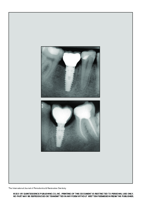 (PDF) Influence of implant placement depth and soft tissue thickness on ...