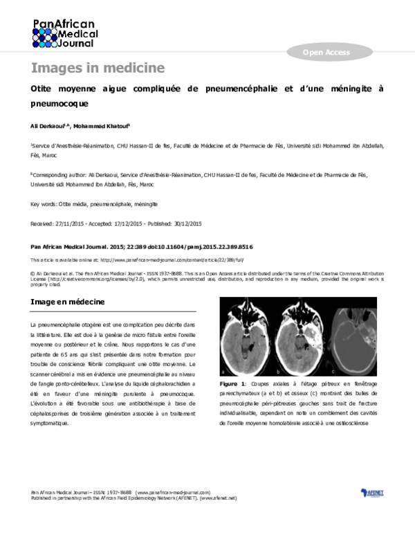 (PDF) Otite moyenne aigue compliquée de pneumencéphalie et d’une ...