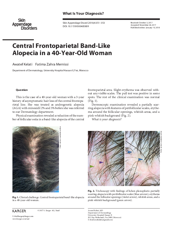 (PDF) Central Frontoparietal Band-Like Alopecia in a 40-Year-Old Woman