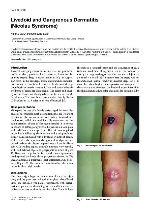 (PDF) Livedoid and Gangrenous Dermatitis ( Nicolau Syndrome ) | Fekete ...