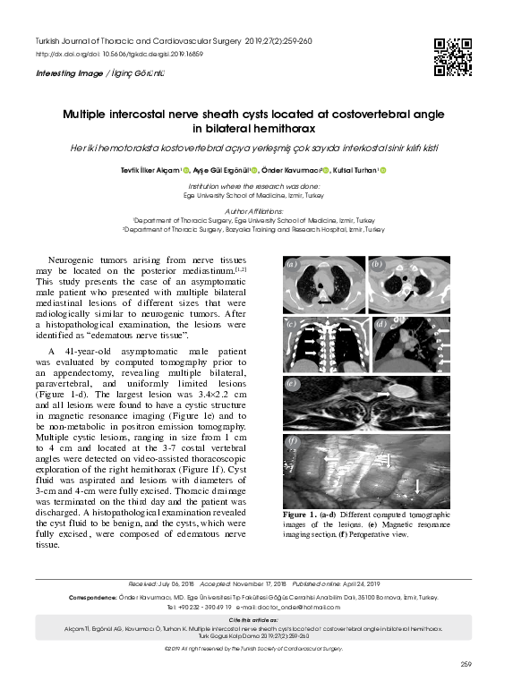 (PDF) Multiple intercostal nerve sheath cysts located at costovertebral ...
