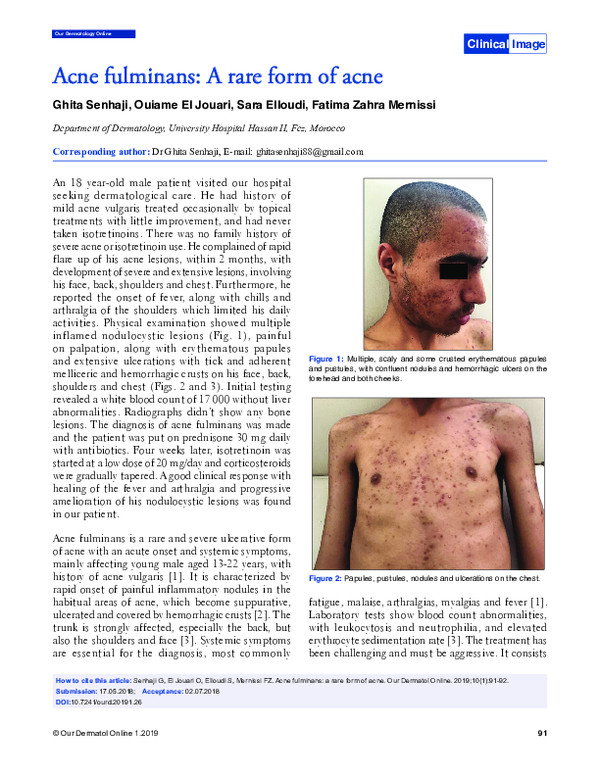 (PDF) Acne fulminans: a rare form of acne